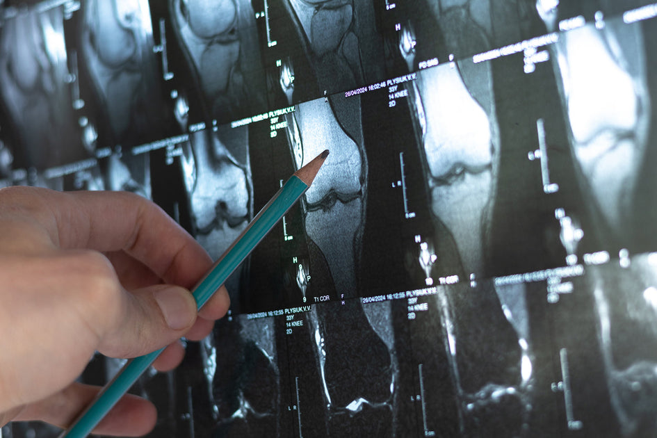 Optimizing Bone Health: A Holistic Approach to Stronger Bone – BrocElite